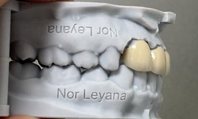 China Cobalt Chrome PFM Crown from china dental lab for sale