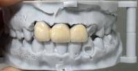 China Cobalt Chrome PFM Crown from china dental lab for sale