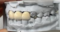 China Cobalt Chrome PFM Crown from china dental lab for sale