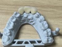 China Cobalt Chrome PFM Crown from china dental lab for sale