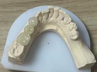 China Custom CAD/CAM Digital Design Temporary Teeth with Natural Appearance and Comfortable Fit for Dental Restoration for sale