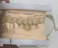 China Custom CAD/CAM Digital Design Temporary Teeth with Natural Appearance and Comfortable Fit for Dental Restoration for sale