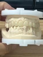 China Custom CAD/CAM Digital Design Temporary Teeth with Natural Appearance and Comfortable Fit for Dental Restoration for sale