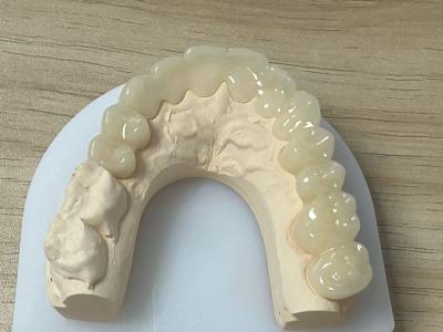 China Custom CAD/CAM Digital Design Temporary Teeth with Natural Appearance and Comfortable Fit for Dental Restoration for sale