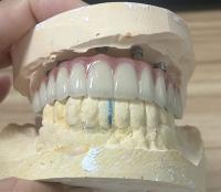 China High-Strength Dental Zirconia Implant Crown with Natural Translucency & Tooth-Like Appearance via Digital CAD/CAM for sale