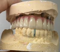 China High-Strength Dental Zirconia Implant Crown with Natural Translucency & Tooth-Like Appearance via Digital CAD/CAM for sale