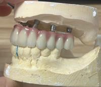China High-Strength Dental Zirconia Implant Crown with Natural Translucency & Tooth-Like Appearance via Digital CAD/CAM for sale