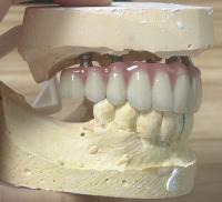 China High-Strength Dental Zirconia Implant Crown with Natural Translucency & Tooth-Like Appearance via Digital CAD/CAM for sale