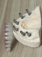 China High-Strength Dental Zirconia Implant Crown with Natural Translucency & Tooth-Like Appearance via Digital CAD/CAM for sale