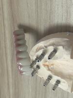 China High-Strength Dental Zirconia Implant Crown with Natural Translucency & Tooth-Like Appearance via Digital CAD/CAM for sale