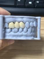 China High Strength Metal-Free Full Zirconia Dental Crown for sale