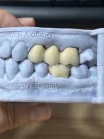 China High Strength Metal-Free Full Zirconia Dental Crown for sale