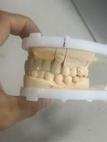 China High Fracture Resistance Full Zirconia Dental Crown with Natural Translucency and CAD/CAM Digital Production for sale