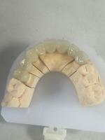 China High Fracture Resistance Full Zirconia Dental Crown with Natural Translucency and CAD/CAM Digital Production for sale