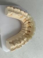 China Anterior Full Zirconia Crown with High Translucency and Natural Aesthetics via Patient-Specific Digital Design for sale