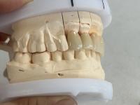 China Anterior Full Zirconia Crown with High Translucency and Natural Aesthetics via Patient-Specific Digital Design for sale