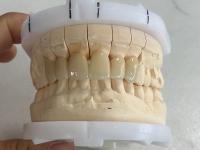 China Anterior Full Zirconia Crown with High Translucency and Natural Aesthetics via Patient-Specific Digital Design for sale