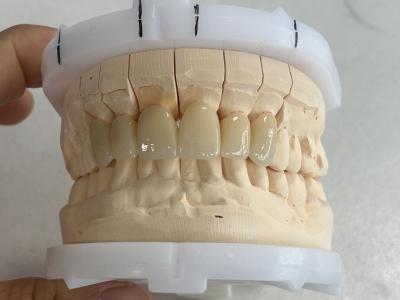 China Anterior Full Zirconia Crown with High Translucency and Natural Aesthetics via Patient-Specific Digital Design for sale