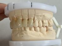 China Anterior Full Zirconia Crown with High Translucency and Natural Aesthetics via Patient-Specific Digital Design for sale