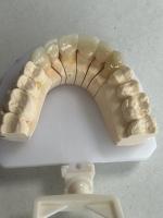 China Anterior Full Zirconia Crown with High Translucency and Natural Aesthetics via Patient-Specific Digital Design for sale