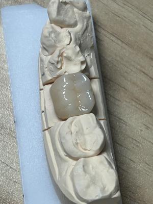 China High-Strength Dental Zirconia Crown with Patient-Specific Digital Design and CAD/CAM Production for Posterior Teeth for sale