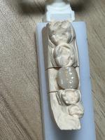 China High-Strength Dental Zirconia Crown with Patient-Specific Digital Design and CAD/CAM Production for Posterior Teeth for sale