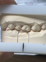 China High-Strength Dental Zirconia Crown with Patient-Specific Digital Design and CAD/CAM Production for Posterior Teeth for sale