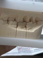 China High-Strength Dental Zirconia Crown with Patient-Specific Digital Design and CAD/CAM Production for Posterior Teeth for sale