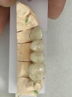 China Cobalt Chrome PFM Crown for sale