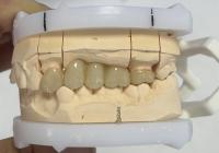 China Custom Full Zirconia Dental Bridge with CAD/CAM Digital Design for Natural-Looking Aesthetics and Metal-Free Restoration for sale