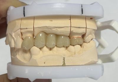 China Custom Full Zirconia Dental Bridge with CAD/CAM Digital Design for Natural-Looking Aesthetics and Metal-Free Restoration for sale