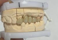 China Custom Full Zirconia Dental Bridge with CAD/CAM Digital Design for Natural-Looking Aesthetics and Metal-Free Restoration for sale