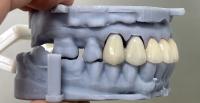 China CAD/CAM Digital Design Temporary Dental Bridge with Natural Tooth-Like Appearance in PMMA / Acrylic Resin for sale