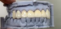 China CAD/CAM Digital Design Temporary Dental Bridge with Natural Tooth-Like Appearance in PMMA / Acrylic Resin for sale