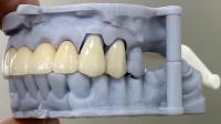 China CAD/CAM Digital Design Temporary Dental Bridge with Natural Tooth-Like Appearance in PMMA / Acrylic Resin for sale