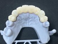 China CAD/CAM Digital Design Temporary Dental Bridge with Natural Tooth-Like Appearance in PMMA / Acrylic Resin for sale