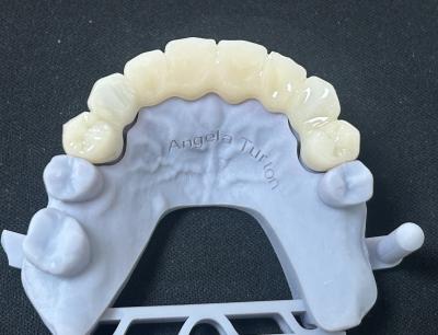China CAD/CAM Digital Design Temporary Dental Bridge with Natural Tooth-Like Appearance in PMMA / Acrylic Resin for sale