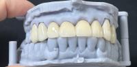 China CAD/CAM Digital Design Temporary Dental Bridge with Natural Tooth-Like Appearance in PMMA / Acrylic Resin for sale
