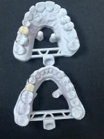 China Conservative Cobalt Chrome No-Prep Dental Bridge with Strong Co-Cr Framework and Precise Digital Design for sale