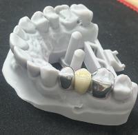 China Conservative Cobalt Chrome No-Prep Dental Bridge with Strong Co-Cr Framework and Precise Digital Design for sale