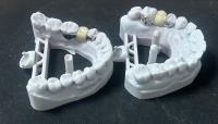 China Conservative Cobalt Chrome No-Prep Dental Bridge with Strong Co-Cr Framework and Precise Digital Design for sale