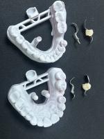 China Conservative Cobalt Chrome No-Prep Dental Bridge with Strong Co-Cr Framework and Precise Digital Design for sale
