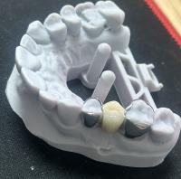 China Conservative Cobalt Chrome No-Prep Dental Bridge with Strong Co-Cr Framework and Precise Digital Design for sale