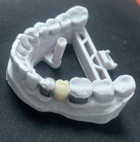 China Conservative Cobalt Chrome No-Prep Dental Bridge with Strong Co-Cr Framework and Precise Digital Design for sale