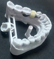 China Conservative Cobalt Chrome No-Prep Dental Bridge with Strong Co-Cr Framework and Precise Digital Design for sale