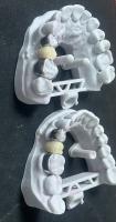 China Conservative Cobalt Chrome No-Prep Dental Bridge with Strong Co-Cr Framework and Precise Digital Design for sale