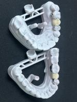 China Conservative Cobalt Chrome No-Prep Dental Bridge with Strong Co-Cr Framework and Precise Digital Design for sale