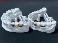 China Conservative Cobalt Chrome No-Prep Dental Bridge with Strong Co-Cr Framework and Precise Digital Design for sale