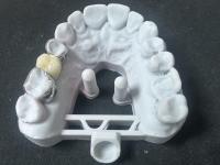 China Conservative Cobalt Chrome No-Prep Dental Bridge with Strong Co-Cr Framework and Precise Digital Design for sale