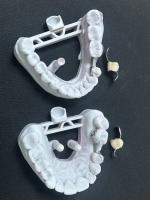 China Conservative Cobalt Chrome No-Prep Dental Bridge with Strong Co-Cr Framework and Precise Digital Design for sale